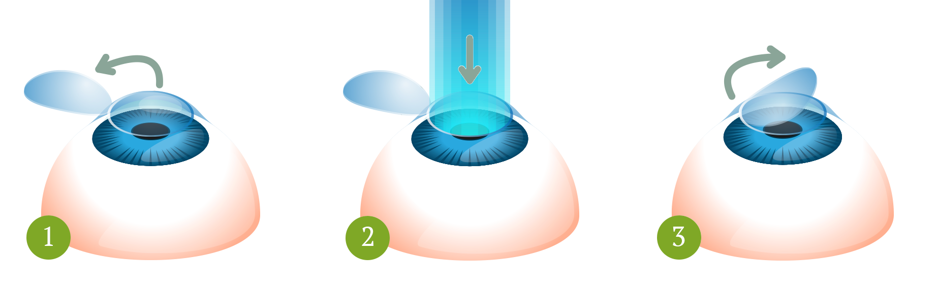 LASIK Eye Surgery Near Me Lacey Tacoma WA | aurora LASIK