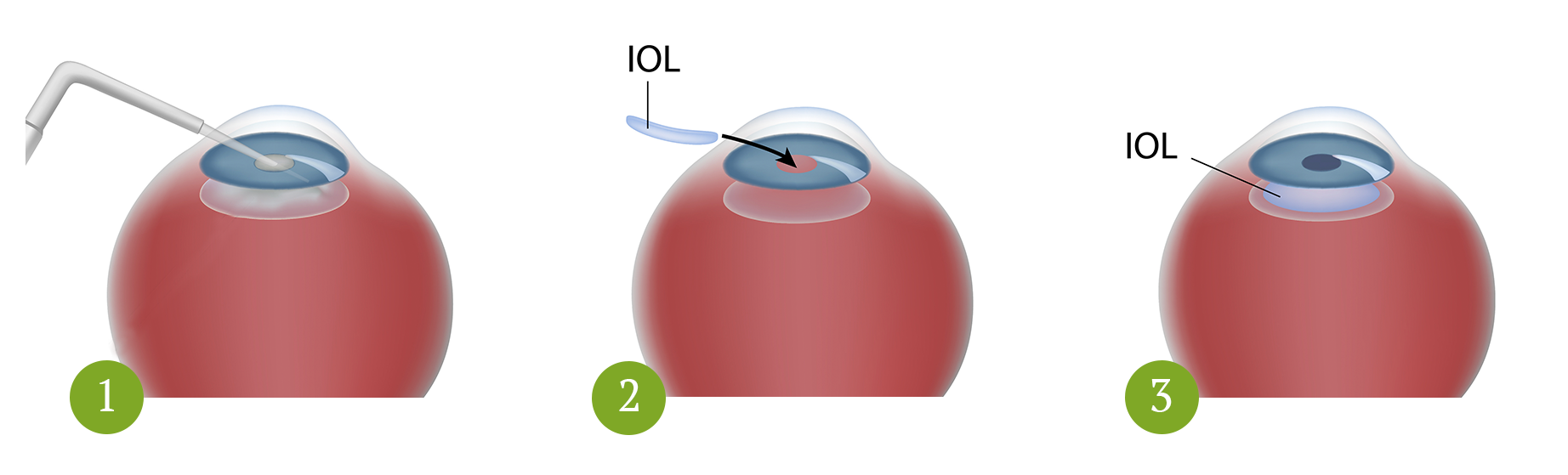 RLE Surgery Near Me serving Olympia, Lacey & Tacoma WA